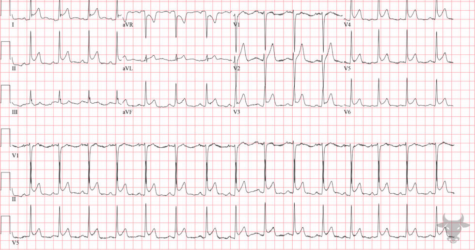 Acute Pericarditis | ECG Stampede