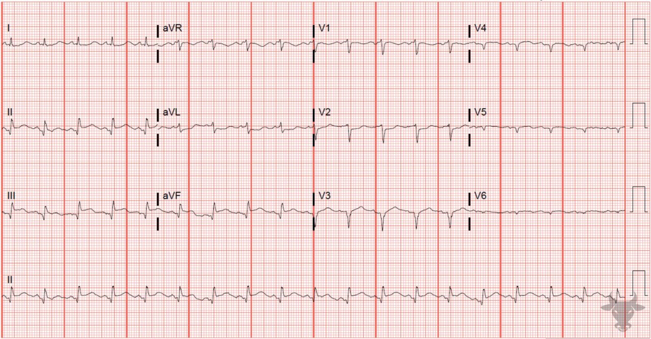 ST-elevation Myocardial Infarction | ECG Stampede