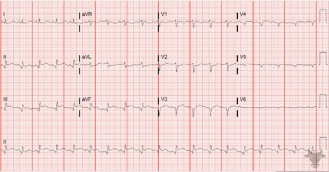 ST-elevation Myocardial Infarction | ECG Stampede