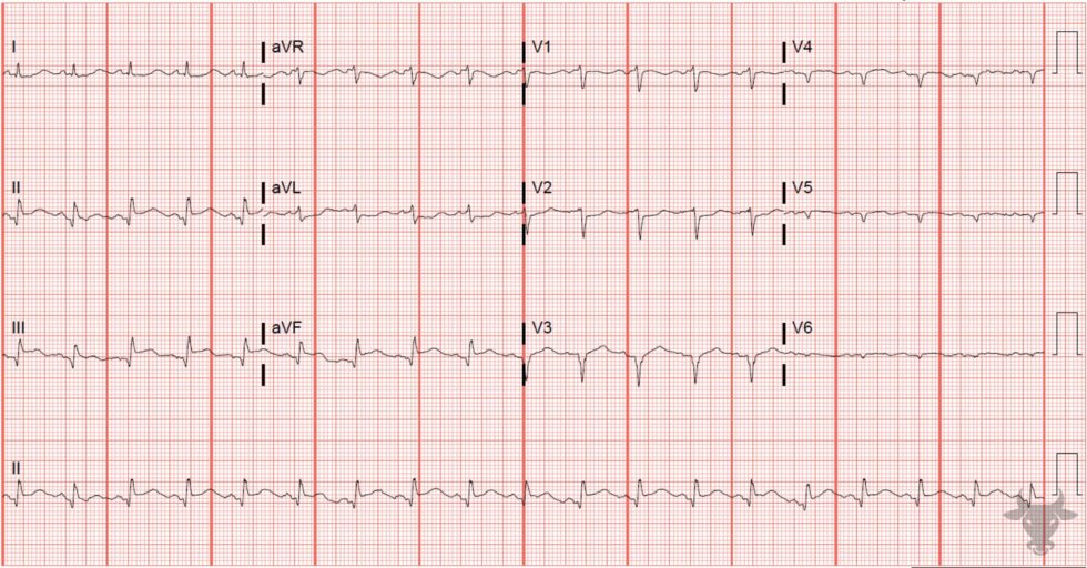 ST-elevation Myocardial Infarction | ECG Stampede
