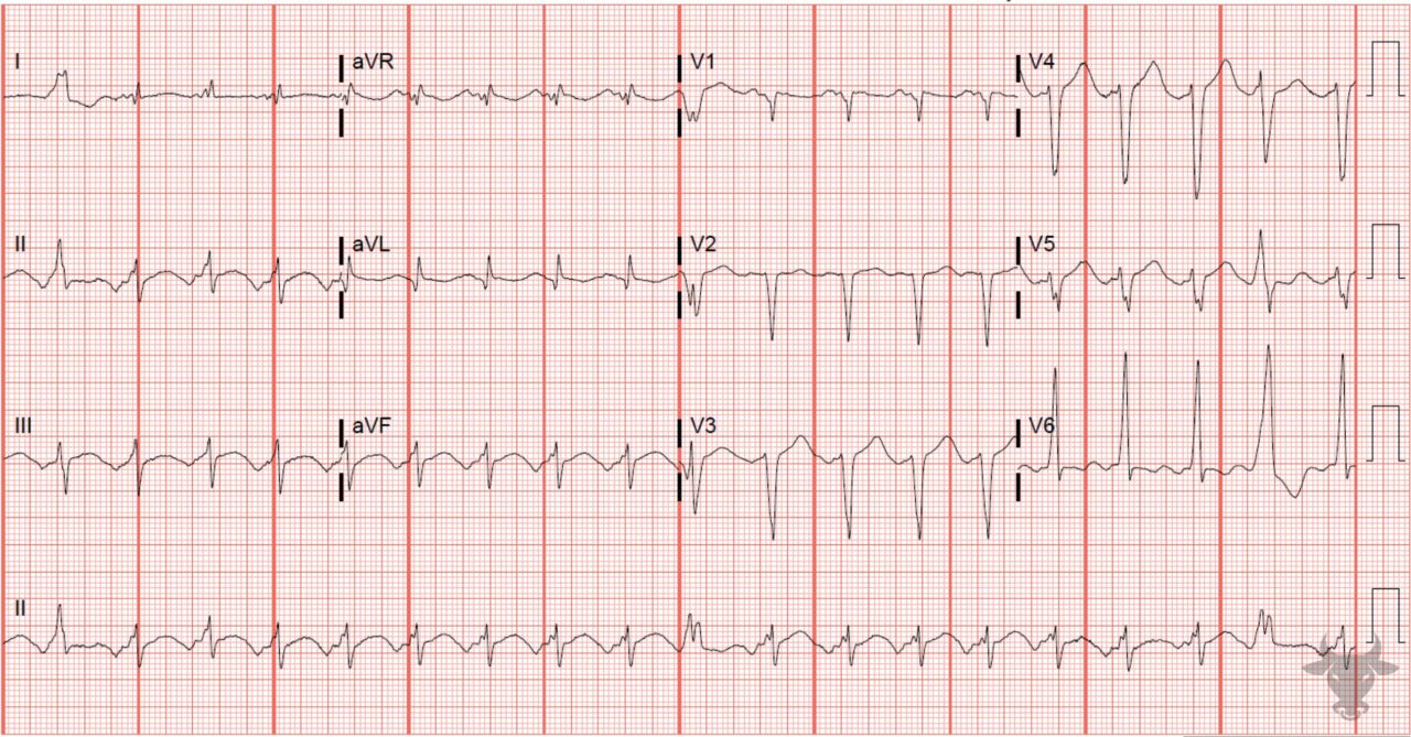 Supraventricular Tachycardia | ECG Stampede