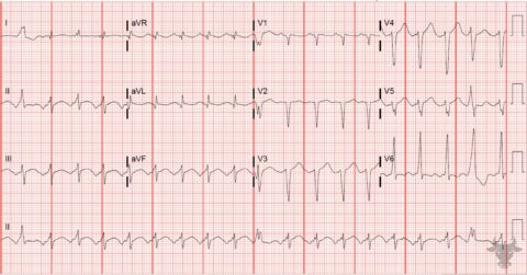 Atrial Tachycardia | ECG Stampede