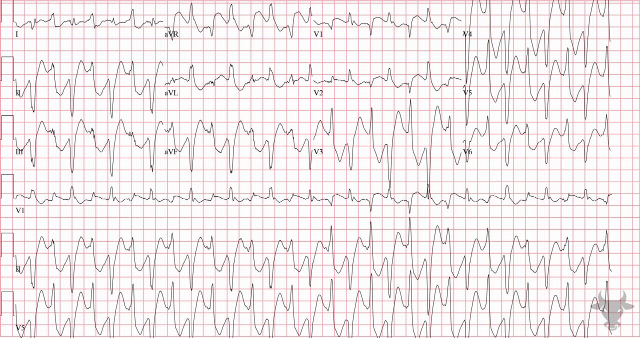 Digoxin Toxicity | ECG Stampede