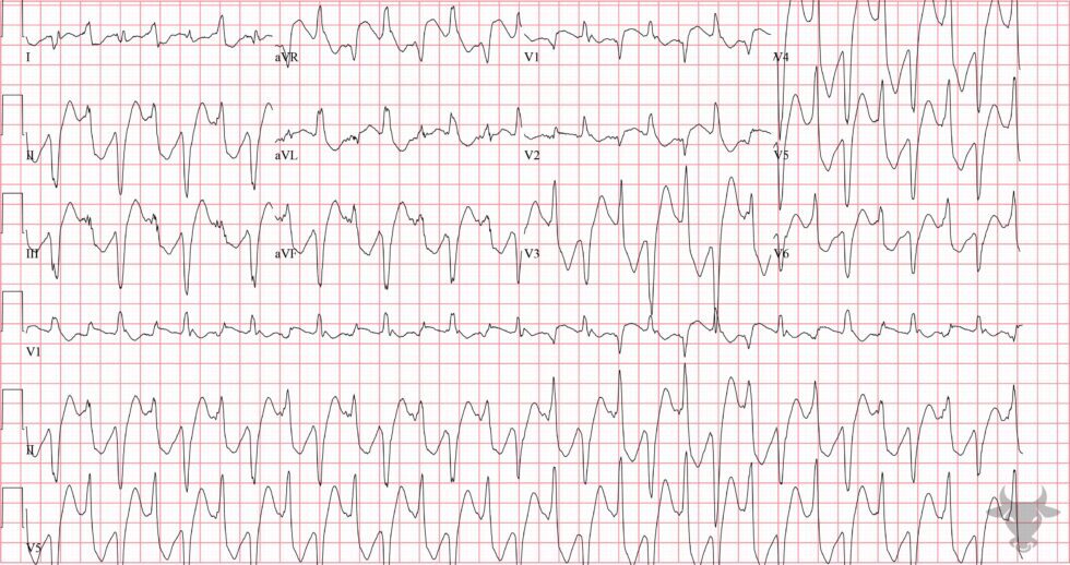 Digoxin Toxicity | ECG Stampede