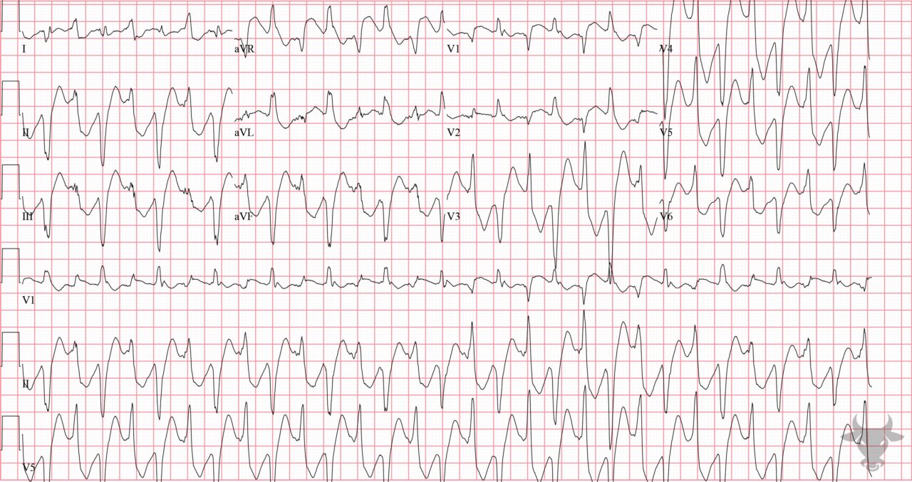 Polymorphic Ventricular Tachycardia | ECG Stampede