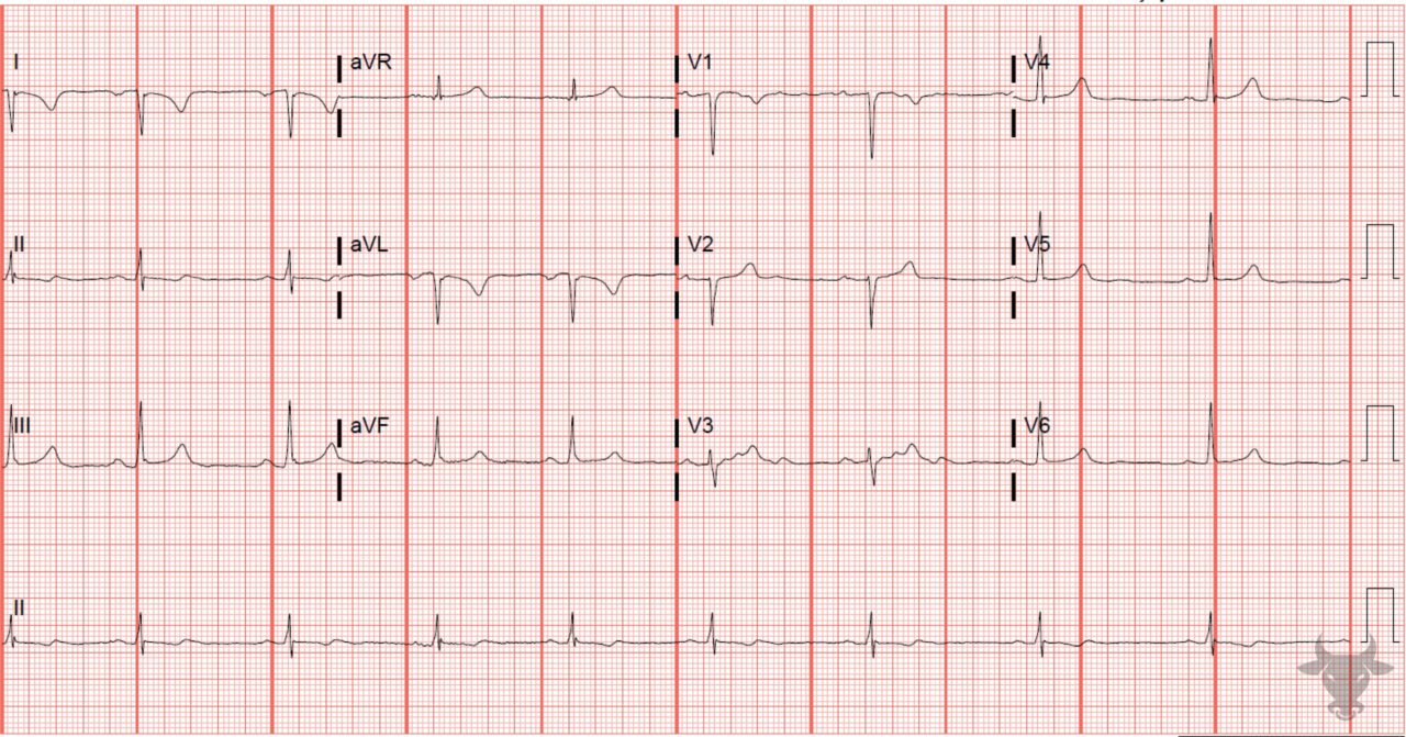 Limb Lead Reversal | ECG Stampede
