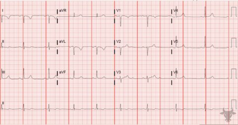 Limb Lead Reversal | ECG Stampede