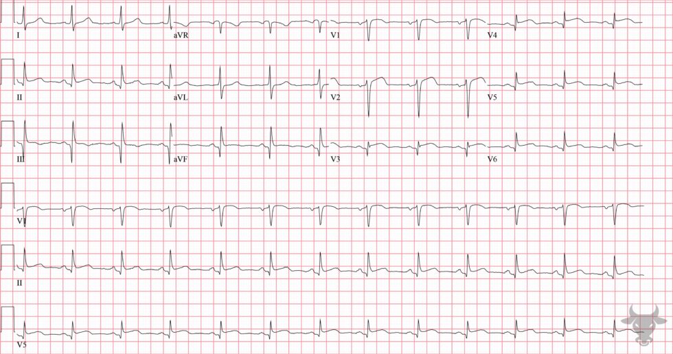 ST-elevation Myocardial Infarction | ECG Stampede