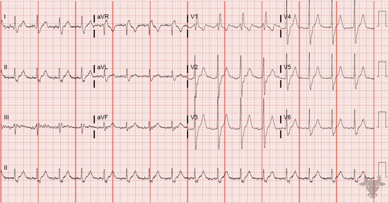 Right Bundle Branch Block | ECG Stampede