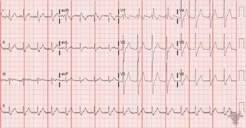 Right Bundle Branch Block | ECG Stampede