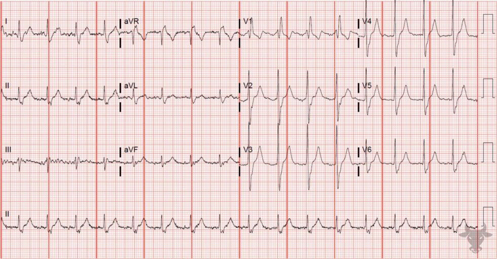 Right Bundle Branch Block | ECG Stampede