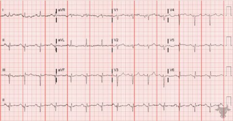 ST-elevation Myocardial Infarction | ECG Stampede