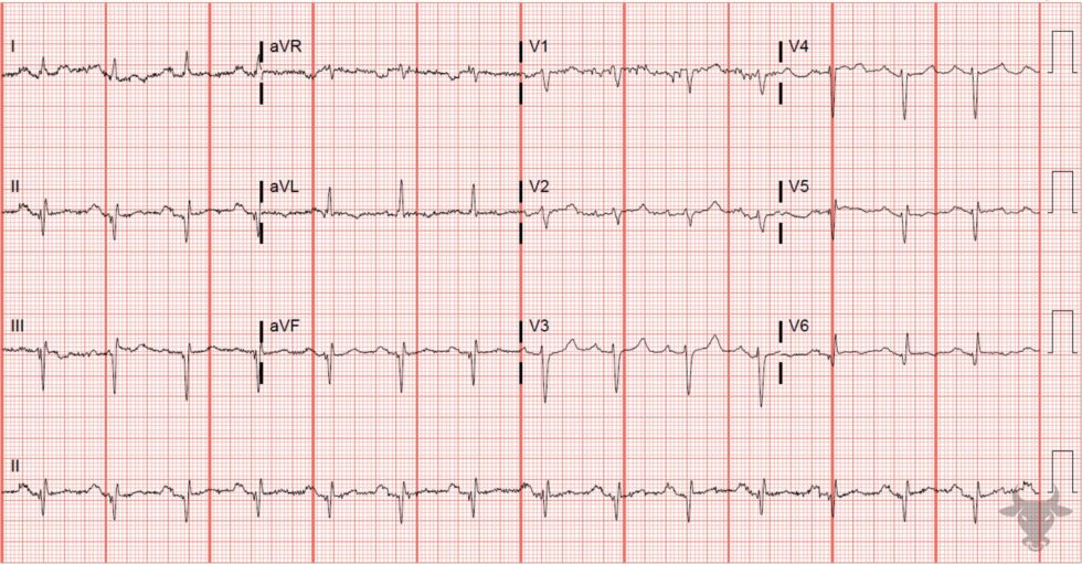ST-elevation Myocardial Infarction | ECG Stampede