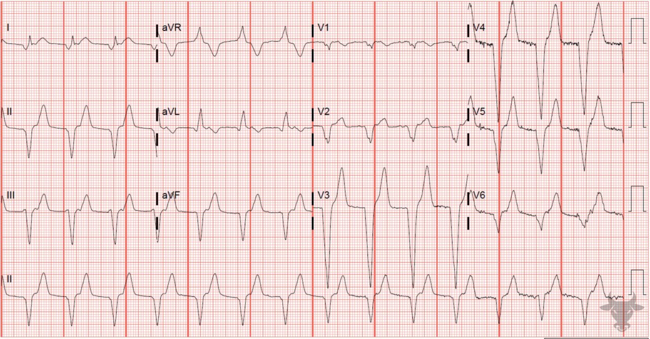 Accelerated Idioventricular Rhythm | ECG Stampede