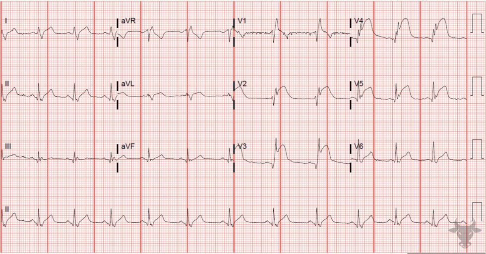 ST-elevation Myocardial Infarction | ECG Stampede