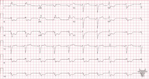Left Bundle Branch Block | ECG Stampede