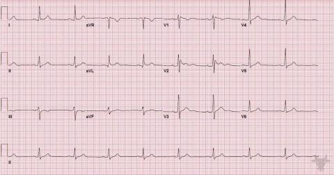 Brugada Syndrome | ECG Stampede