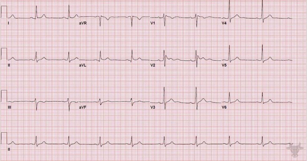 Brugada Syndrome | ECG Stampede