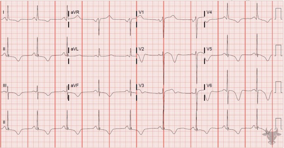 Cerebral T Waves Ecg Stampede