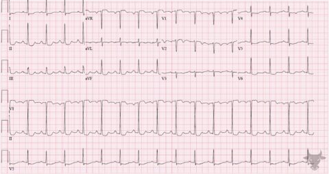 Global Subendocardial Ischemia | ECG Stampede