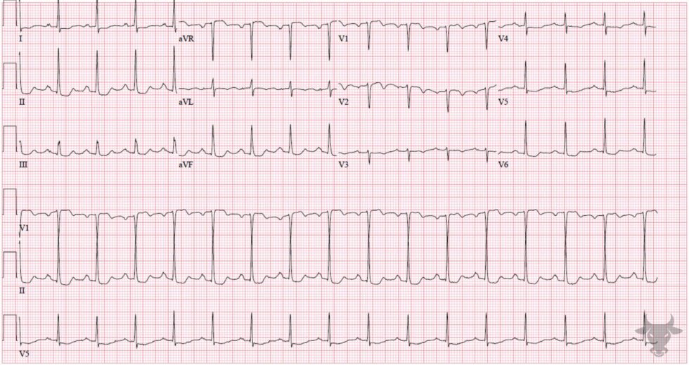 Global Subendocardial Ischemia Ecg Stampede