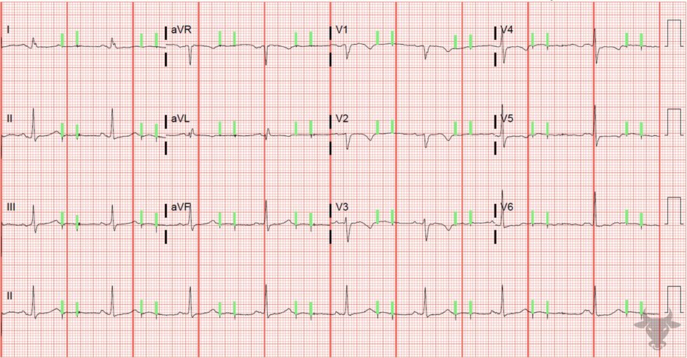 Pacemaker Malfunction | ECG Stampede