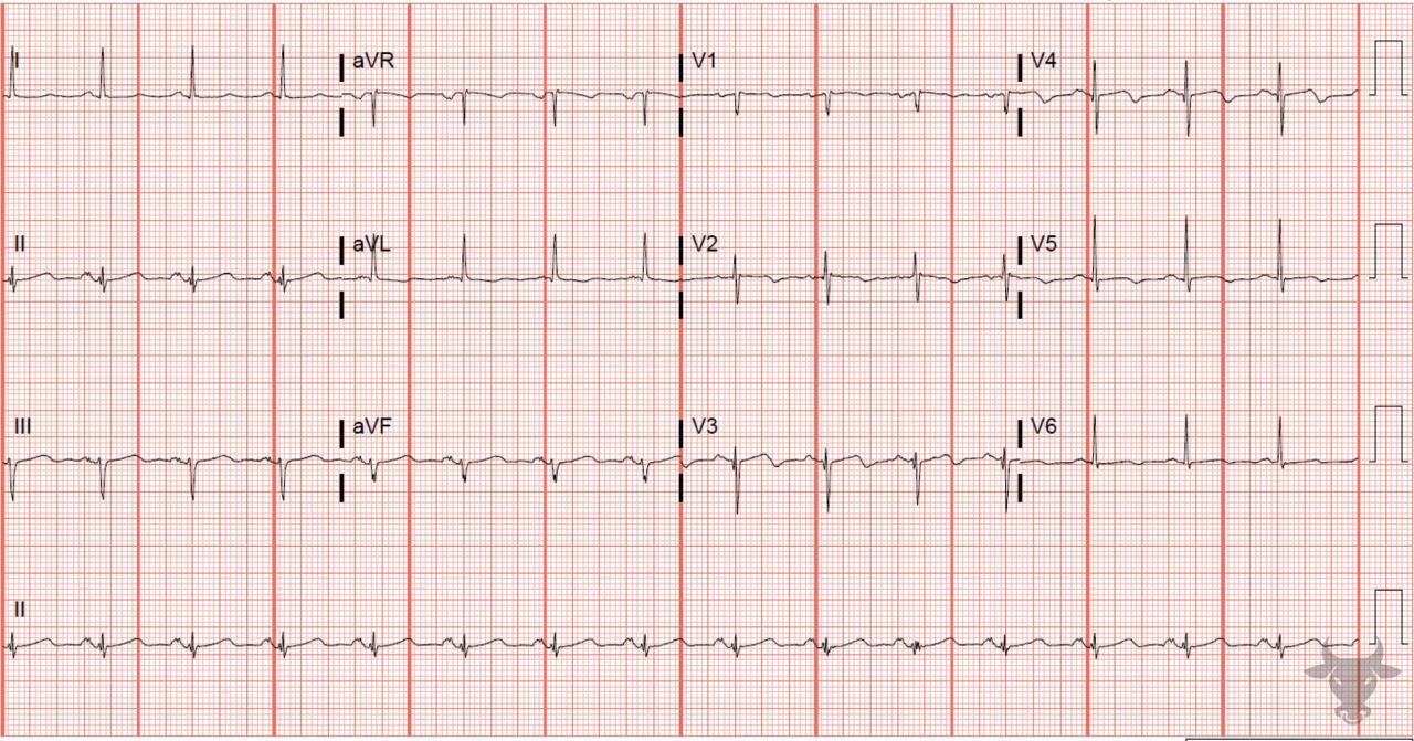 Wellens Syndrome | ECG Stampede