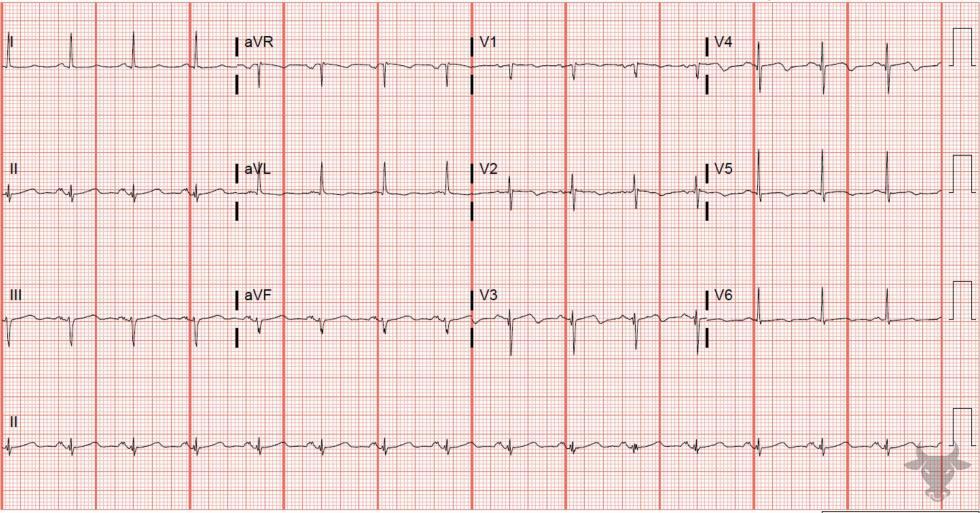 Wellens Syndrome | ECG Stampede