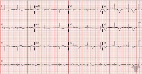 Wellens Syndrome | ECG Stampede