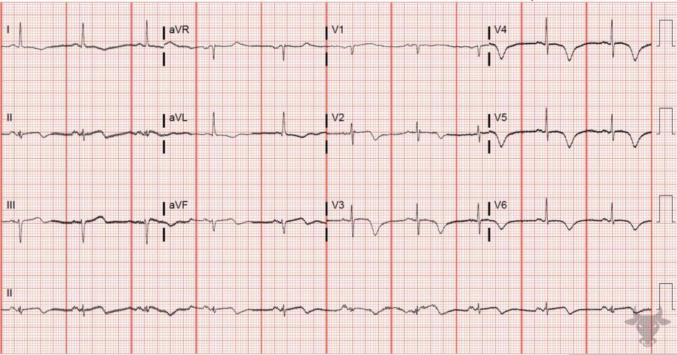 T-wave Inversions | ECG Stampede