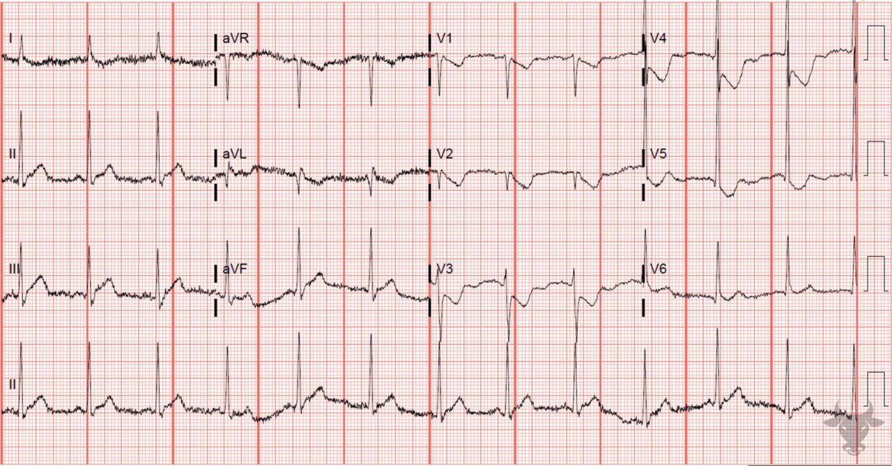 Posterior Myocardial Infarction | ECG Stampede