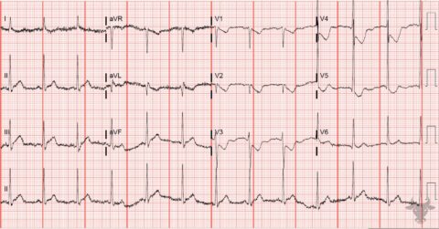 Posterior Myocardial Infarction | ECG Stampede