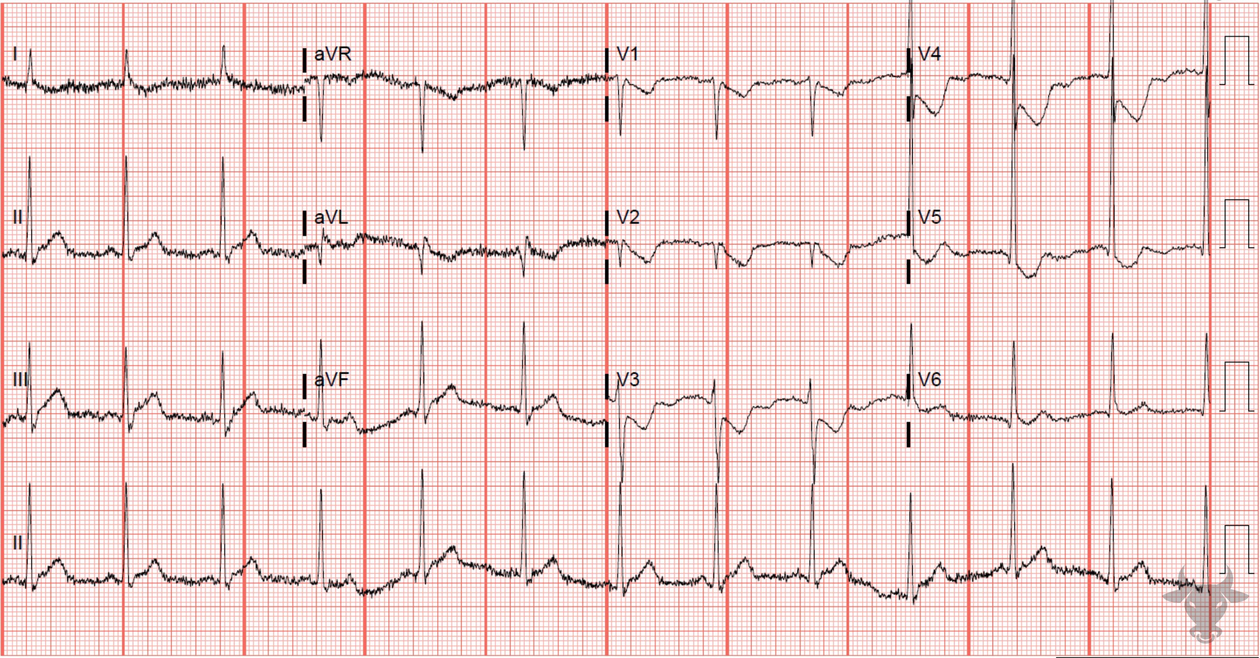 Posterior Myocardial Infarction ECG Stampede
