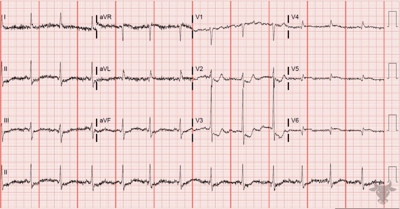 ST-elevation Myocardial Infarction | ECG Stampede