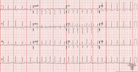 Atrial Fibrillation | ECG Stampede