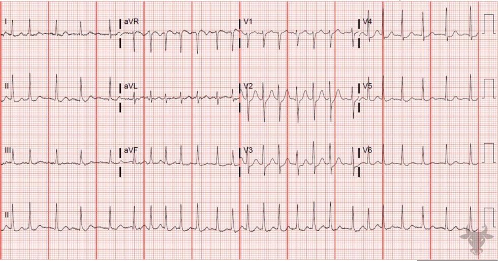 Atrial Fibrillation | ECG Stampede