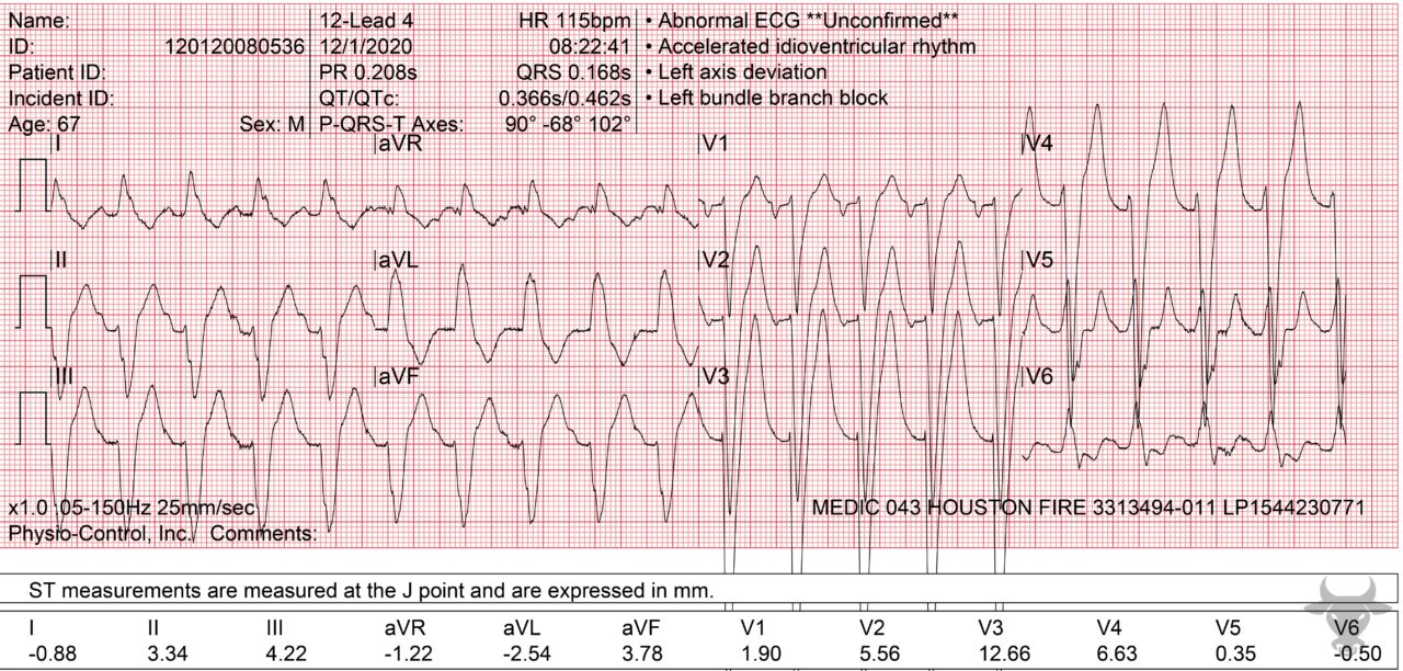 Left Bundle Branch Block | ECG Stampede