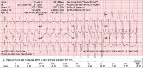 Left Bundle Branch Block | ECG Stampede
