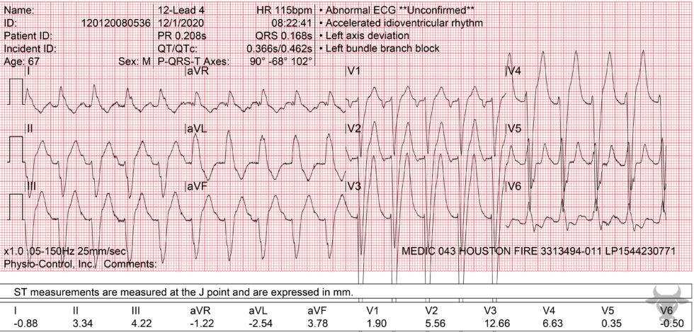 Left Bundle Branch Block | ECG Stampede
