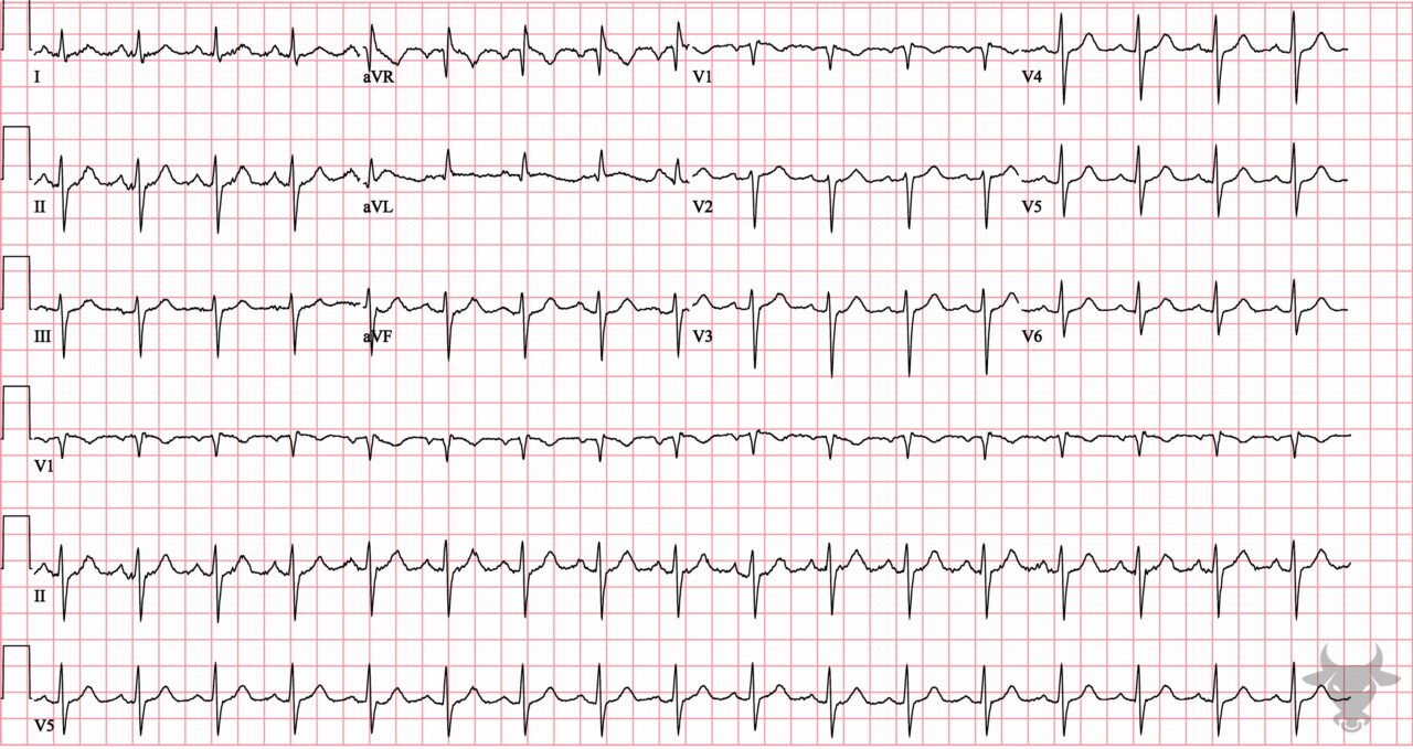 Left Anterior Fascicular Block | ECG Stampede