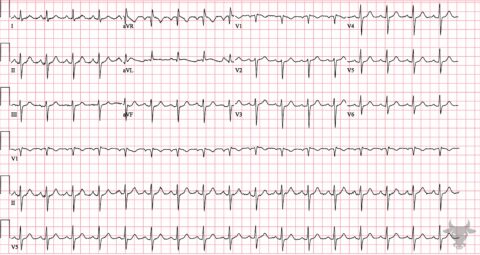 Left Anterior Fascicular Block | ECG Stampede