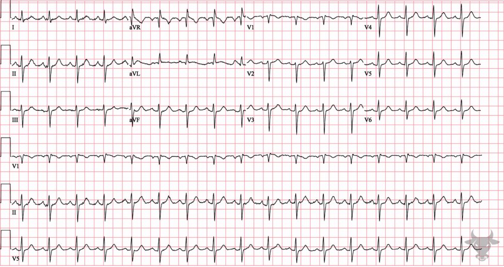Left Anterior Fascicular Block | ECG Stampede