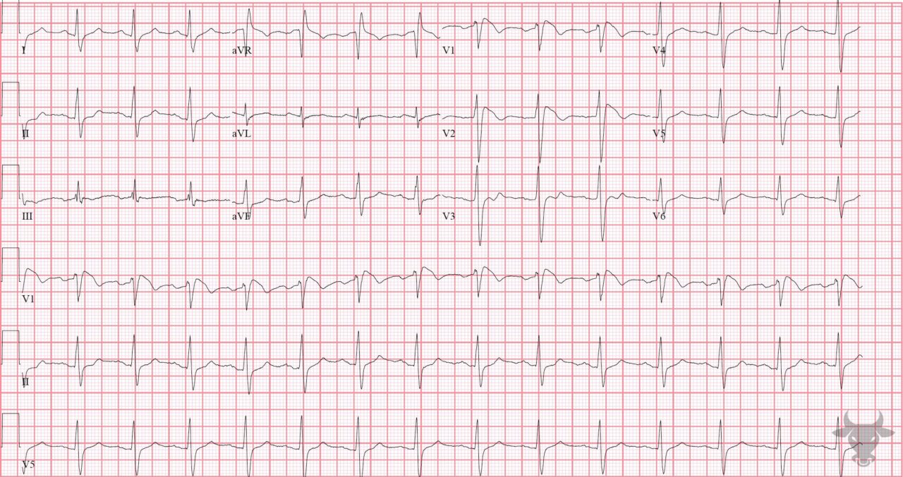Brugada Syndrome | ECG Stampede