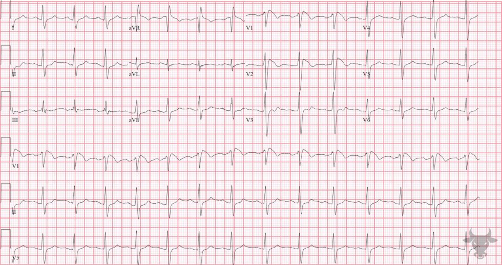 Brugada Syndrome | ECG Stampede