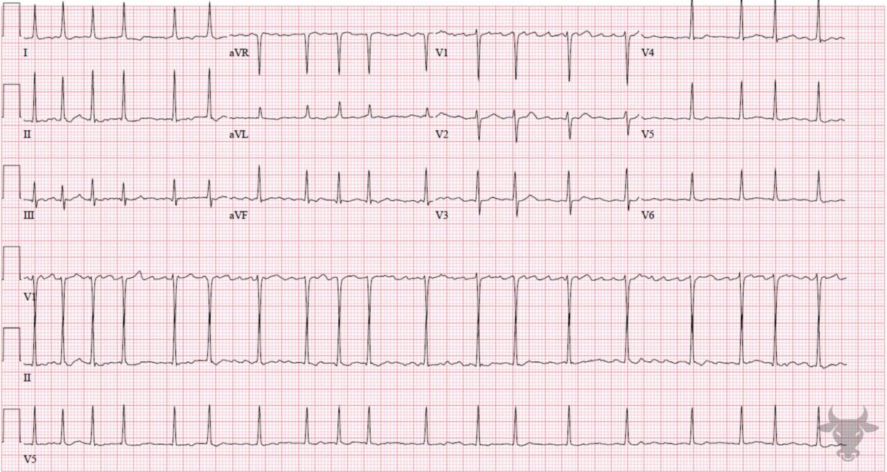 Atrial Fibrillation | ECG Stampede