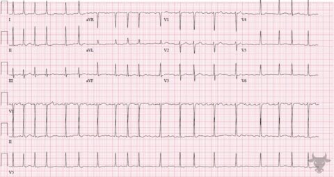 Atrial Fibrillation | ECG Stampede