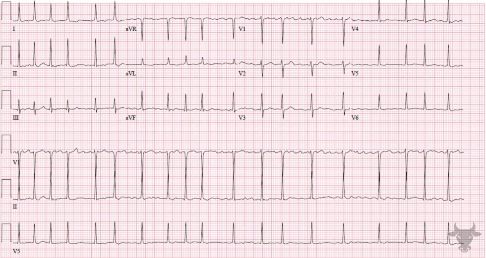 Atrial Fibrillation | ECG Stampede