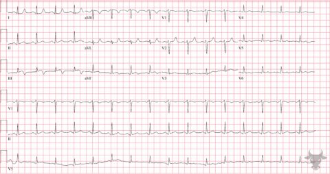 ST-elevation Myocardial Infarction | ECG Stampede