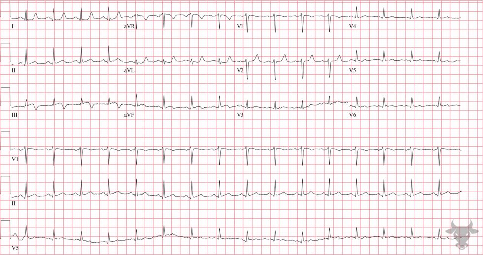 ST-elevation Myocardial Infarction | ECG Stampede
