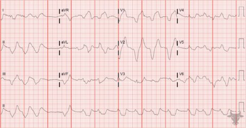 Hyperkalemia | ECG Stampede